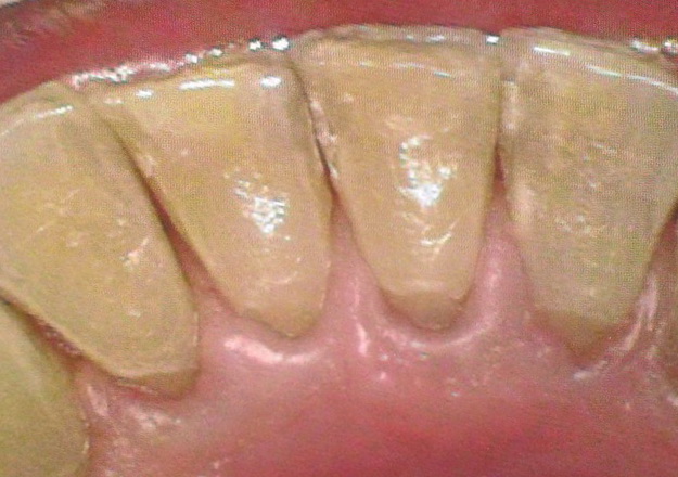 The History of TartarEnd™ - TartarEnd™ Toothpaste
