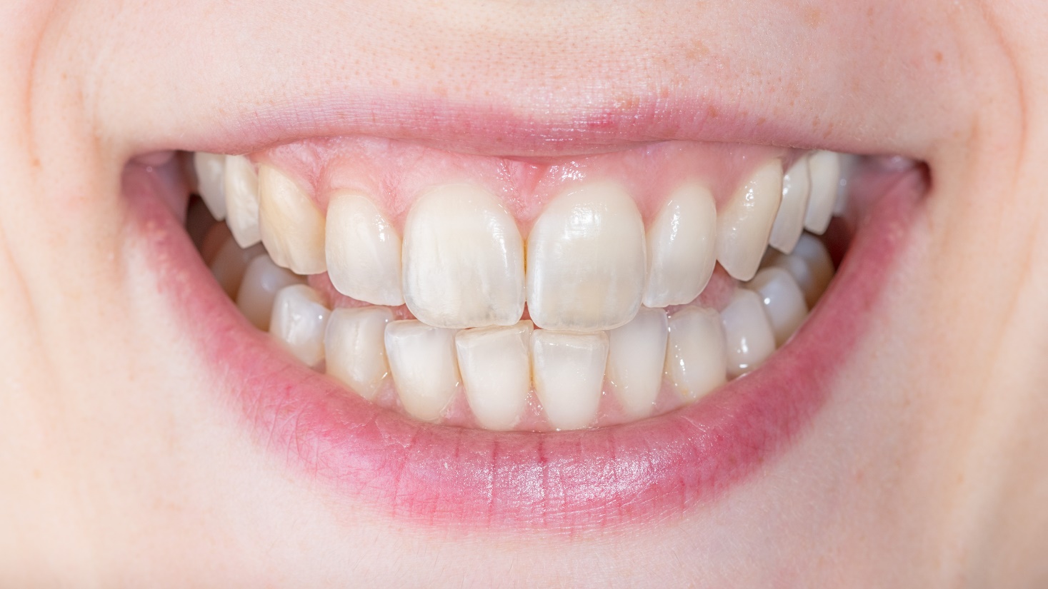 Natural Tooth Remineralization Toothpaste | TartarEnd®