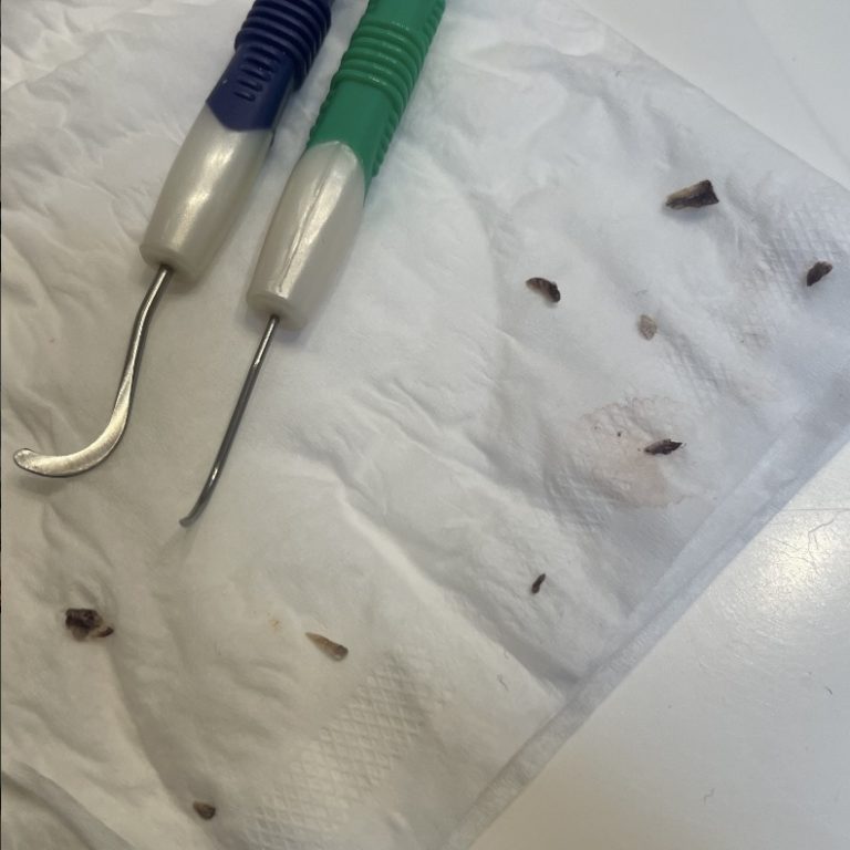 TartarEnd® Tartar Removal Toothpaste - TartarEnd Toothpaste