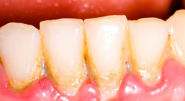 What is Tartar on Teeth & How Can I Prevent It? | Tartar End